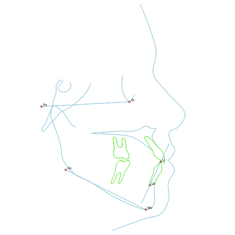 Analyse Céphalométrique en Tunisie - Smart Clinic